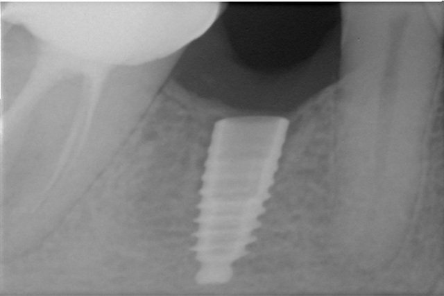 IDI Dental IDcam S Implant dentaire | SpotImplant